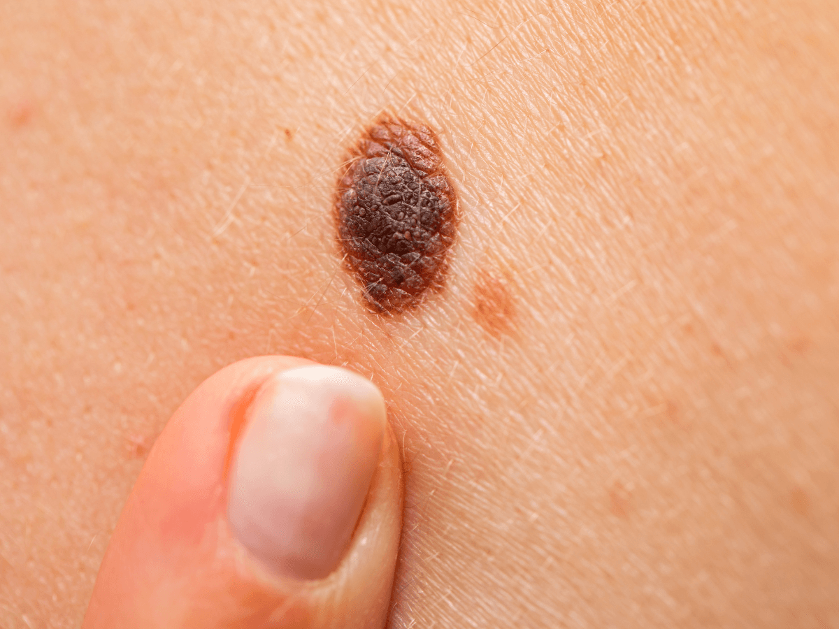 Extrato de cannabis apresenta potencial no tratamento d...